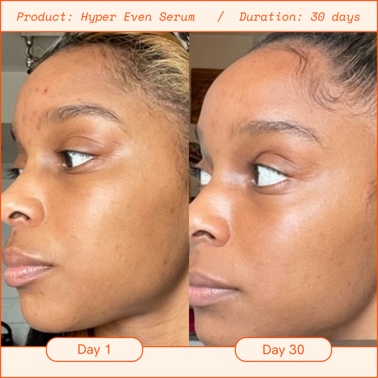 Results SPL – Hyper Skin