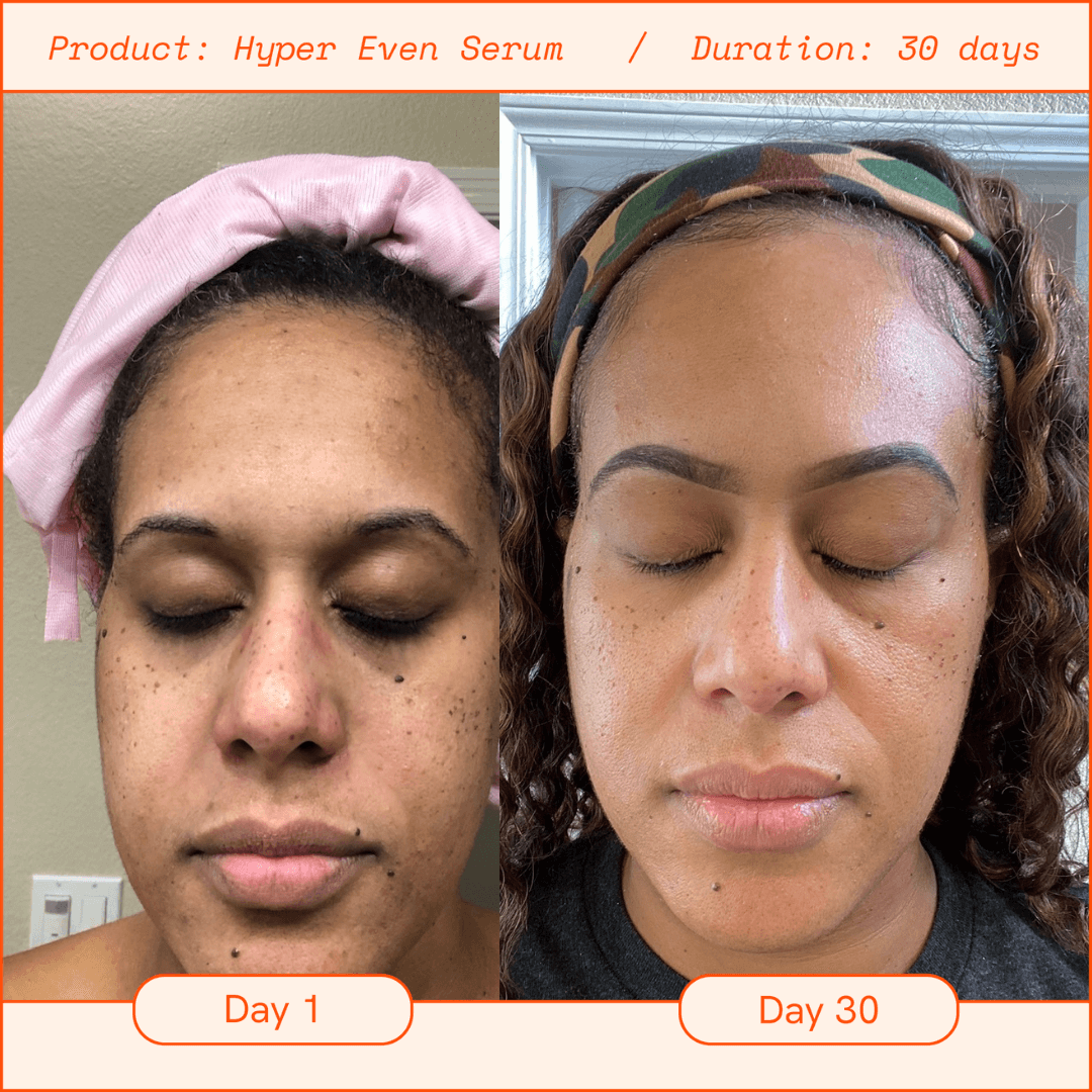 Results SPL – Hyper Skin